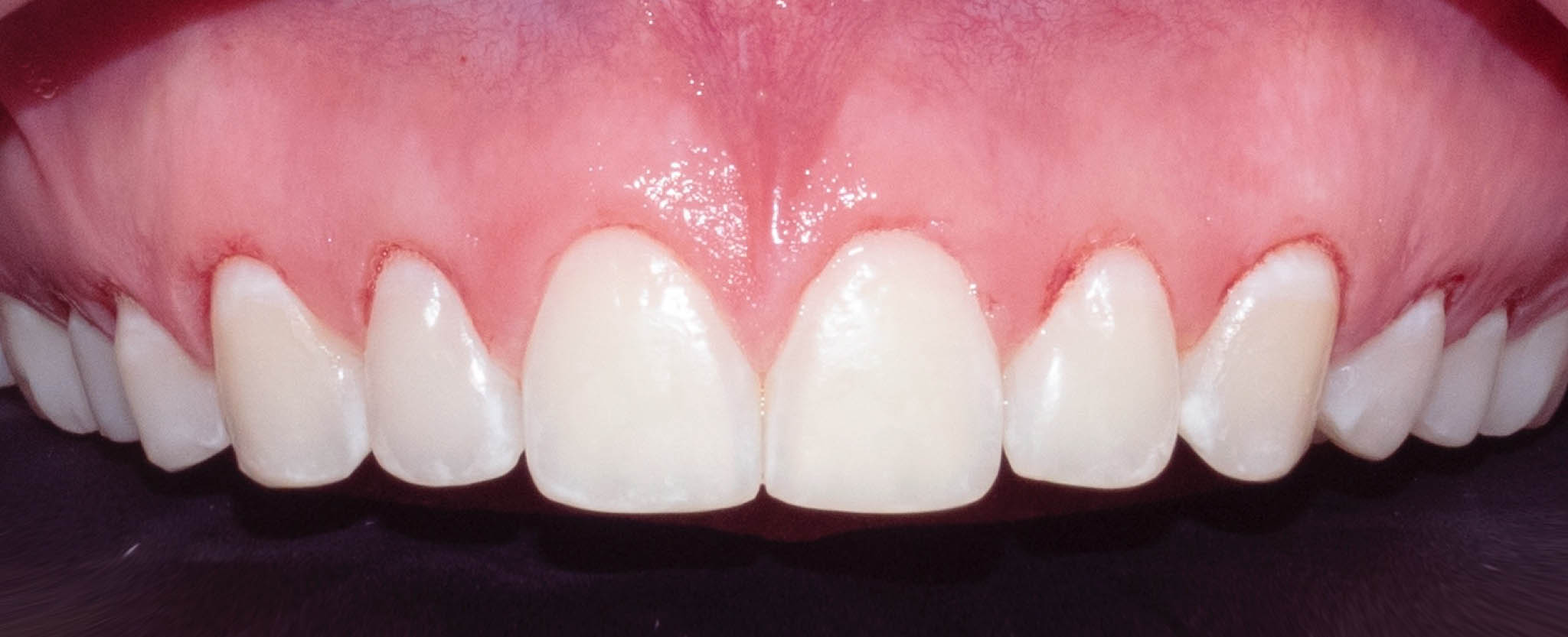 La Gingivoplastia Qué Es Cómo Se Procede Y Cuándo Se Indica