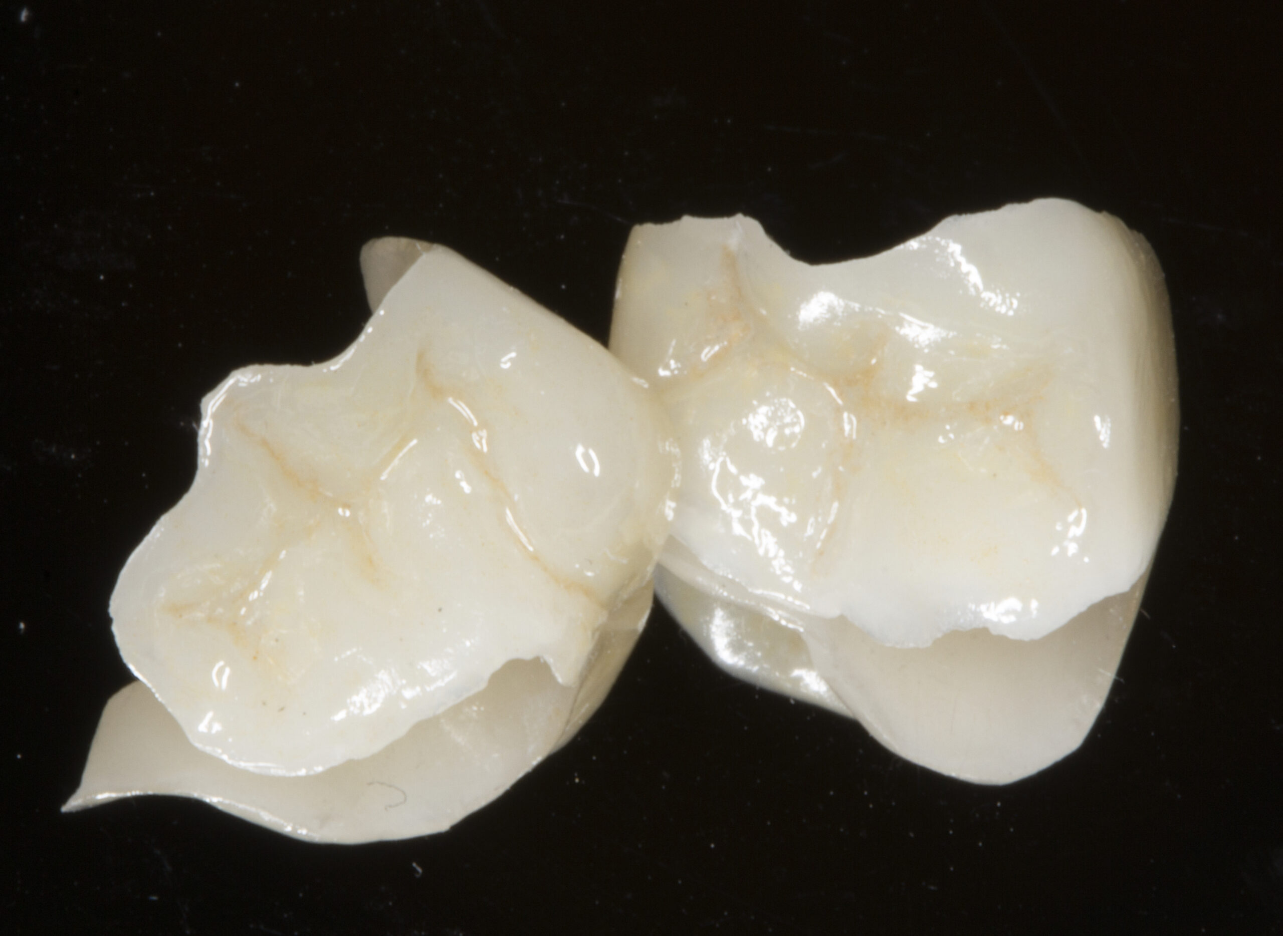 Incrustaciones dentales qué son y para qué sirven